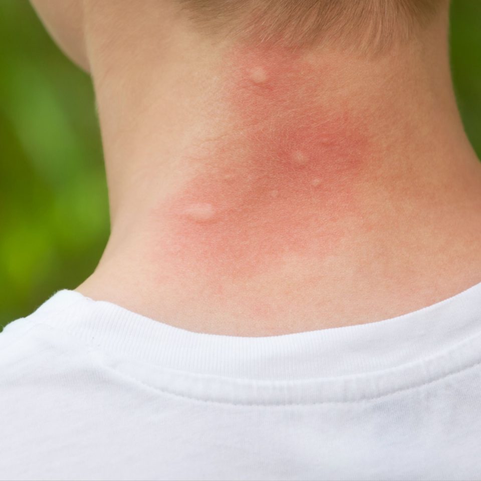 3 Simple Ways To Keep Mosquitoes Out Of Your Yard!